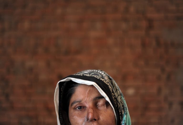 Pakistani hospital developing cost-effective artificial skin for acid ...